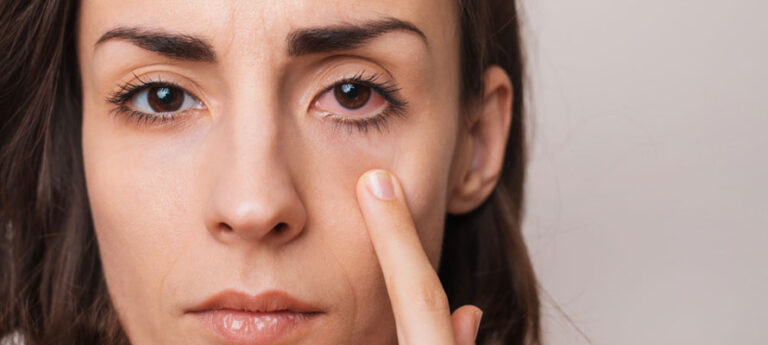 what’s causing watery eyes and how to treat it