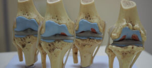 Subchondral Sclerosis: A Guide on Symptoms, Causes, and More
